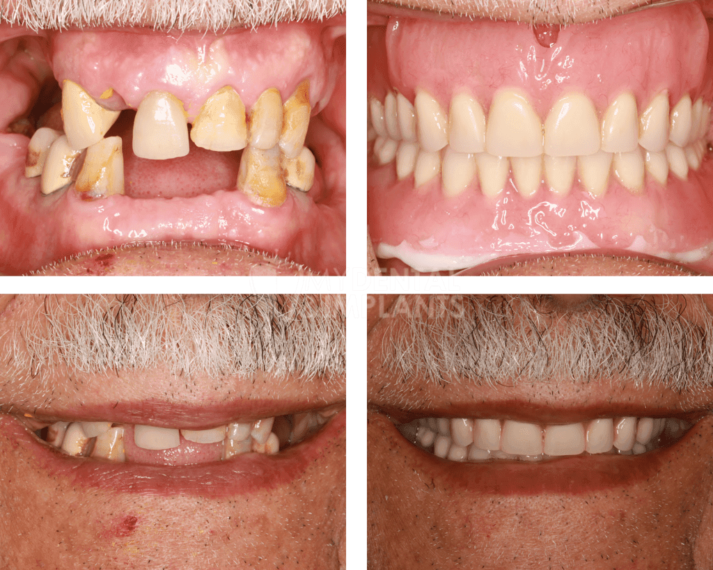 Dentures Glendale AZ - Complete and Partial Dentures